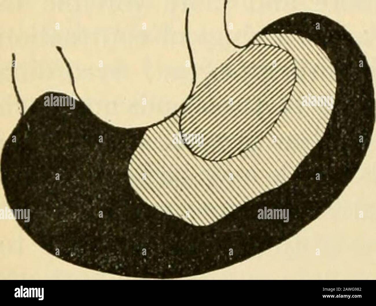 Sfintere pilorico immagini e fotografie stock ad alta risoluzione - Alamy