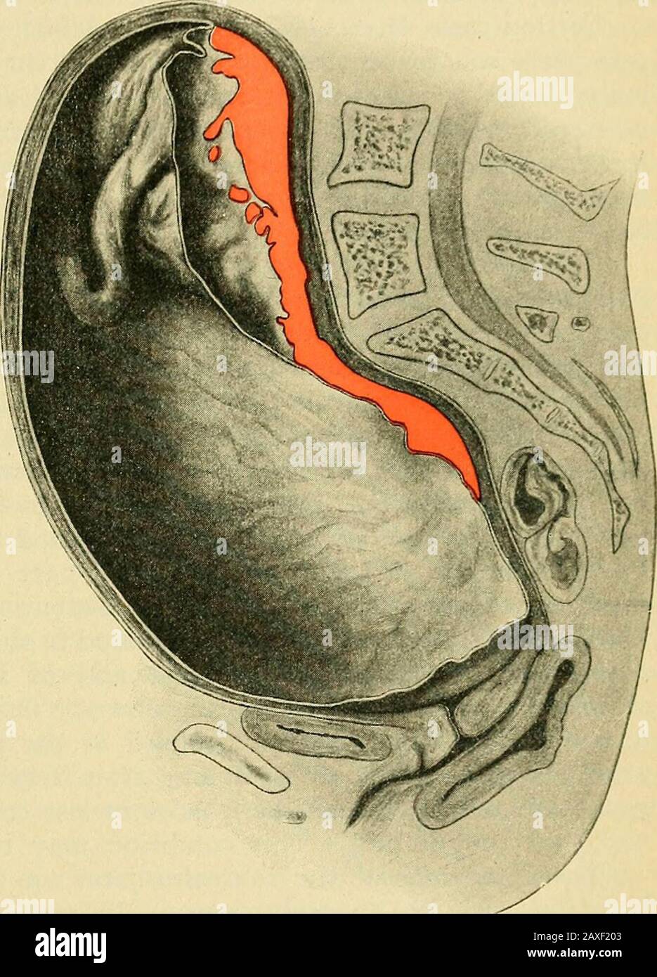 Grossi coaguli di sangue immagini e fotografie stock ad alta ...