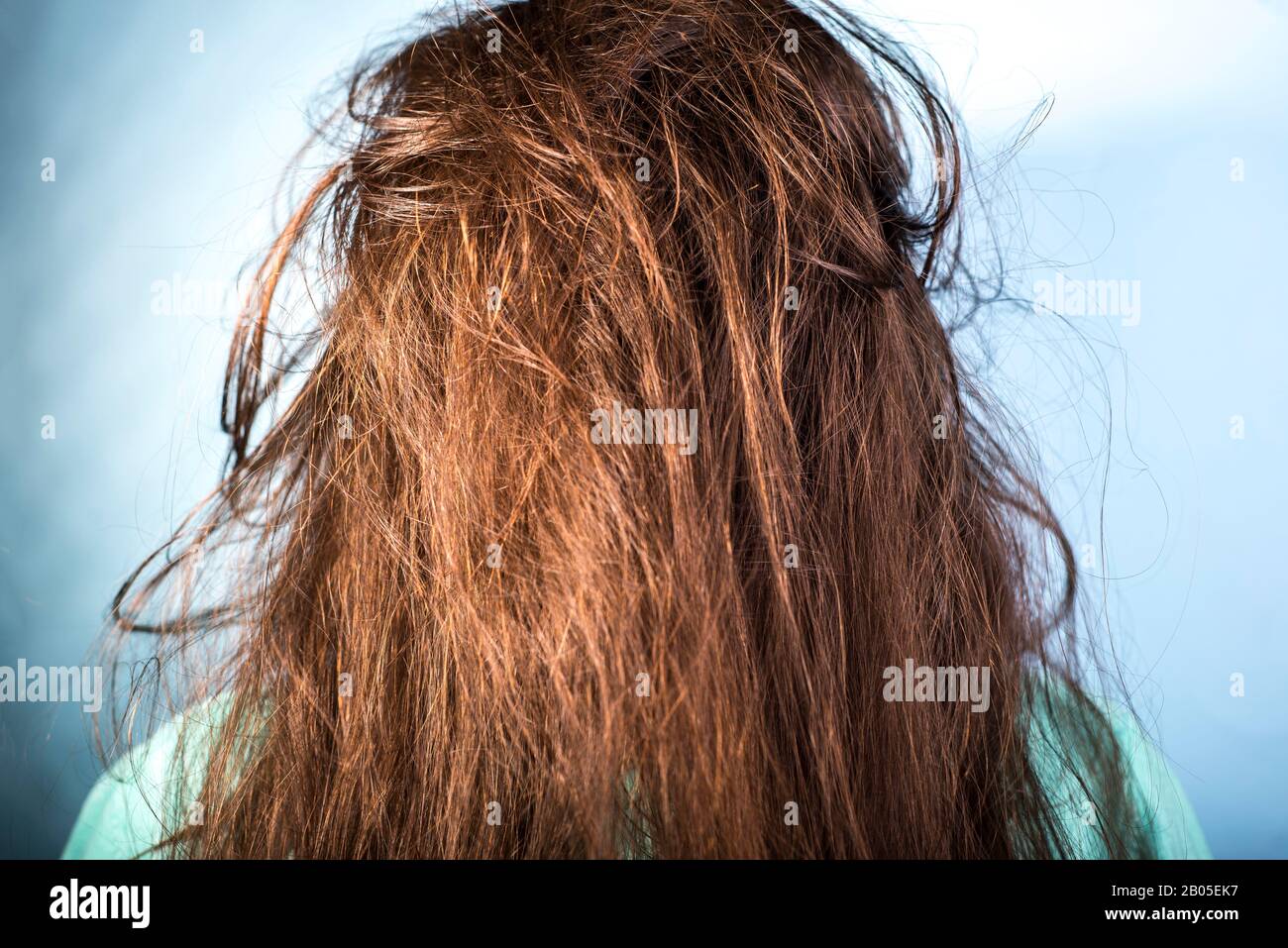 Fungo della pelle malassezia immagini e fotografie stock ad alta ...