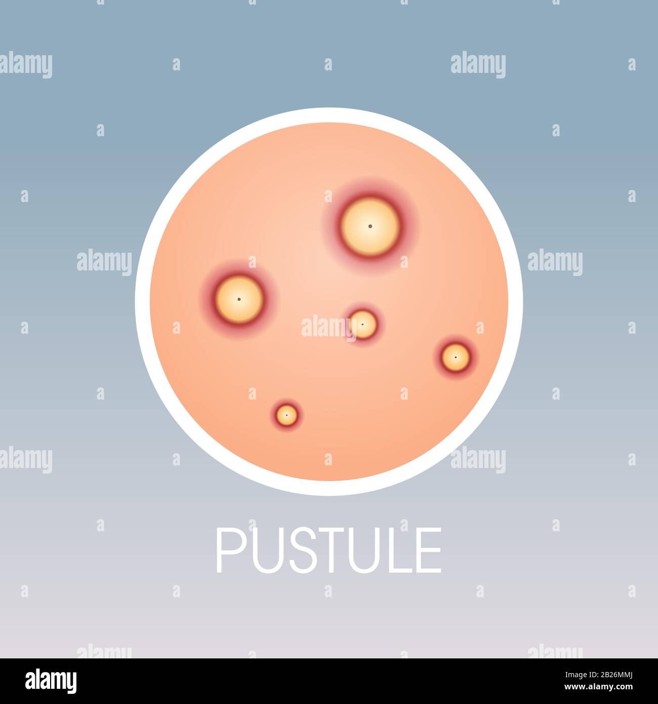 Pustola cutanea immagini e fotografie stock ad alta risoluzione - Alamy