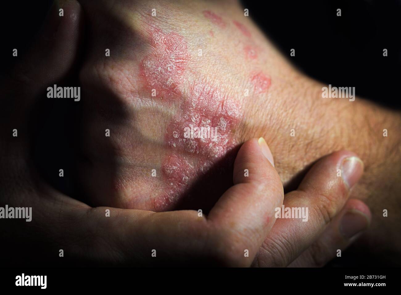 Pelle colpita immagini e fotografie stock ad alta risoluzione - Alamy