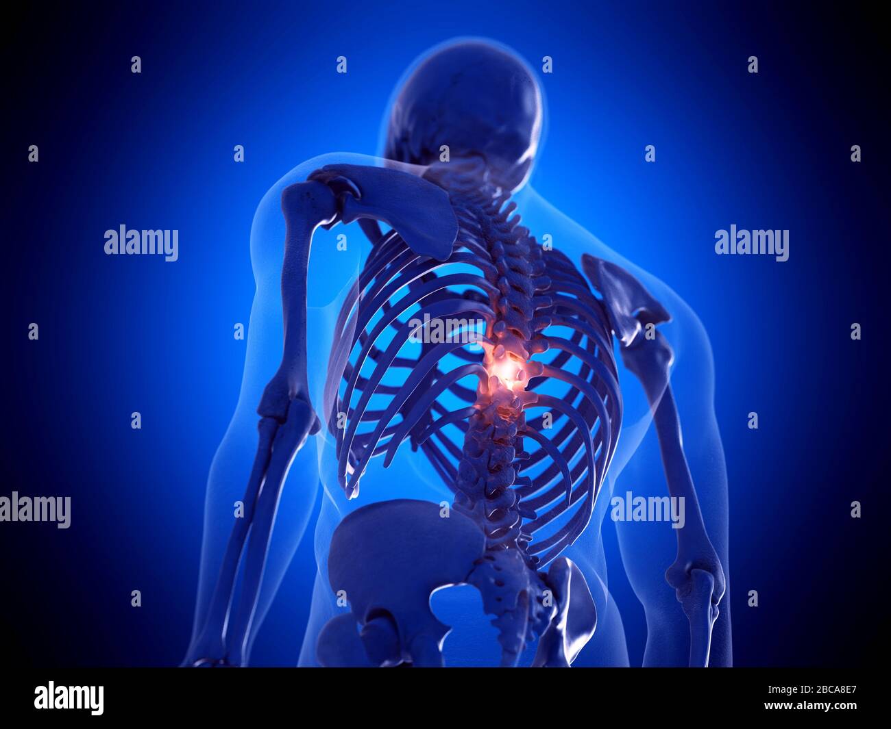 Colonna vertebrale malata immagini e fotografie stock ad alta ...