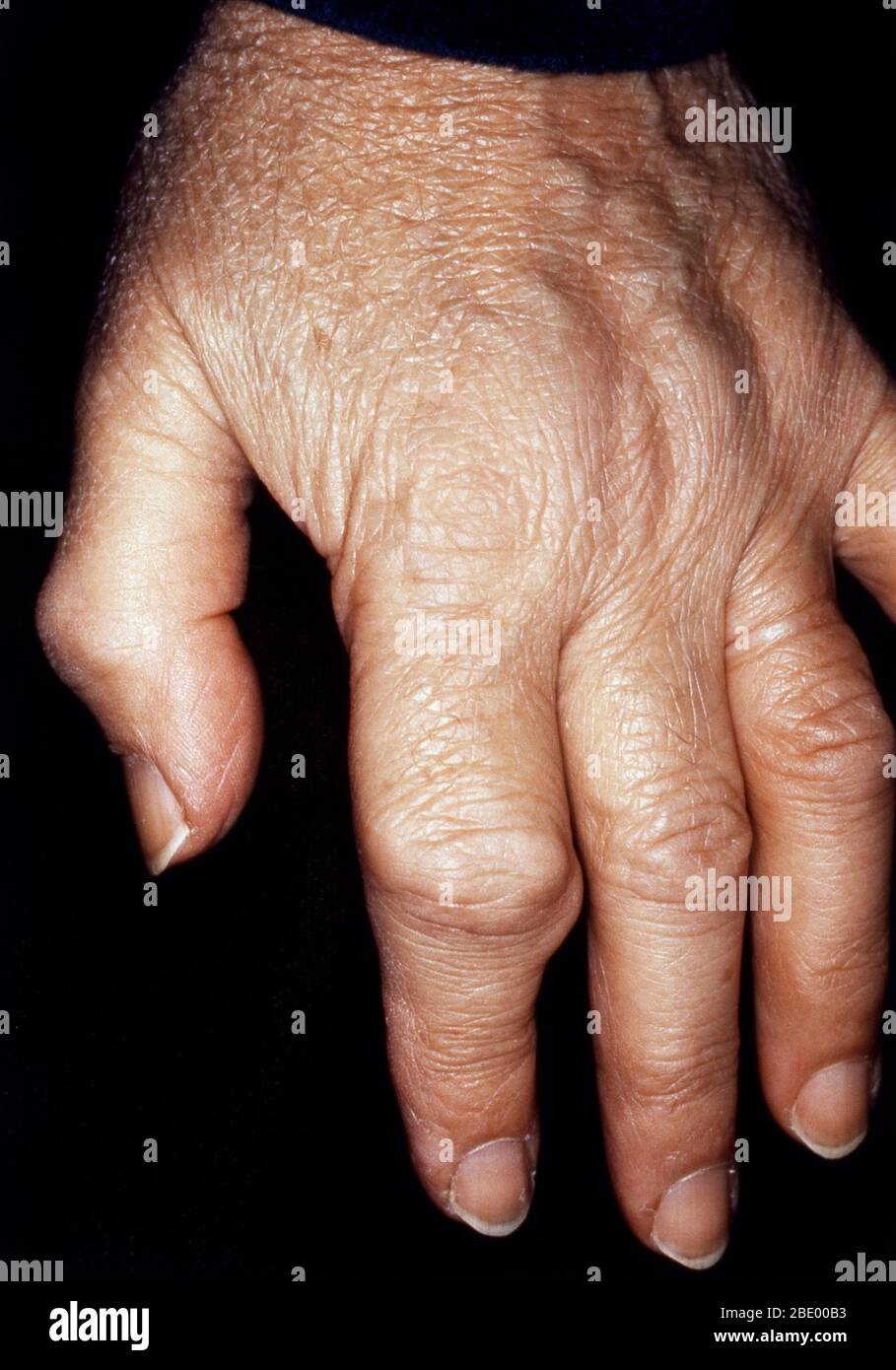 Malattia da artrite reumatoide immagini e fotografie stock ad alta ...