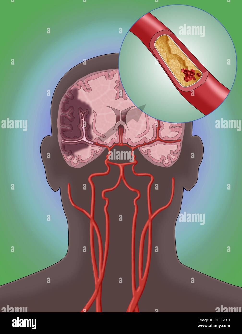 Sangue coagulato immagini e fotografie stock ad alta risoluzione - Alamy