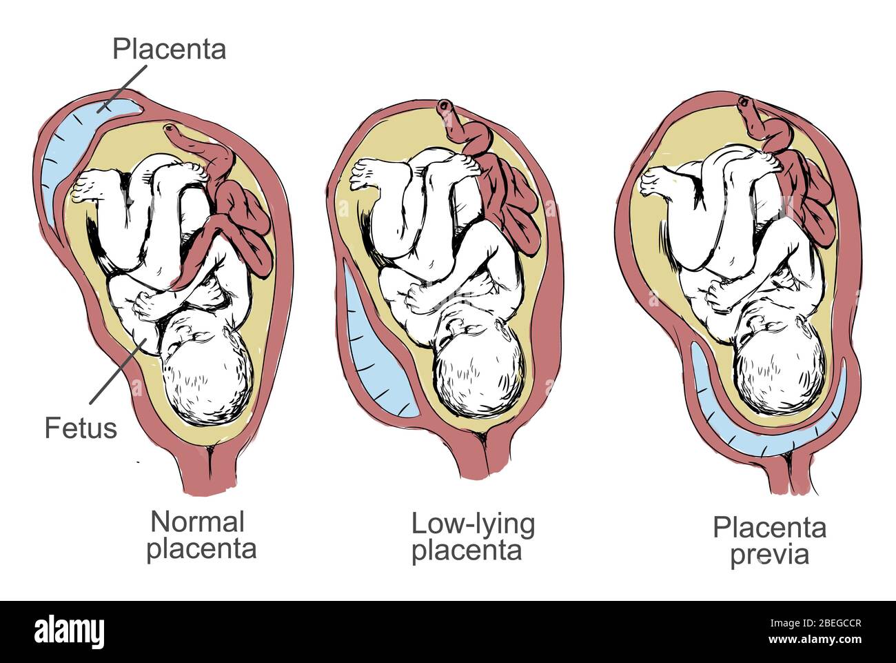 Placenta previa immagini e fotografie stock ad alta risoluzione - Alamy