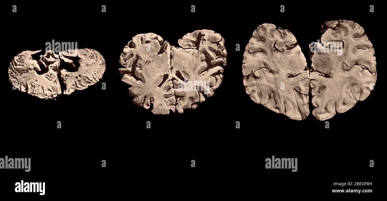 Minamata disease immagini e fotografie stock ad alta risoluzione - Alamy