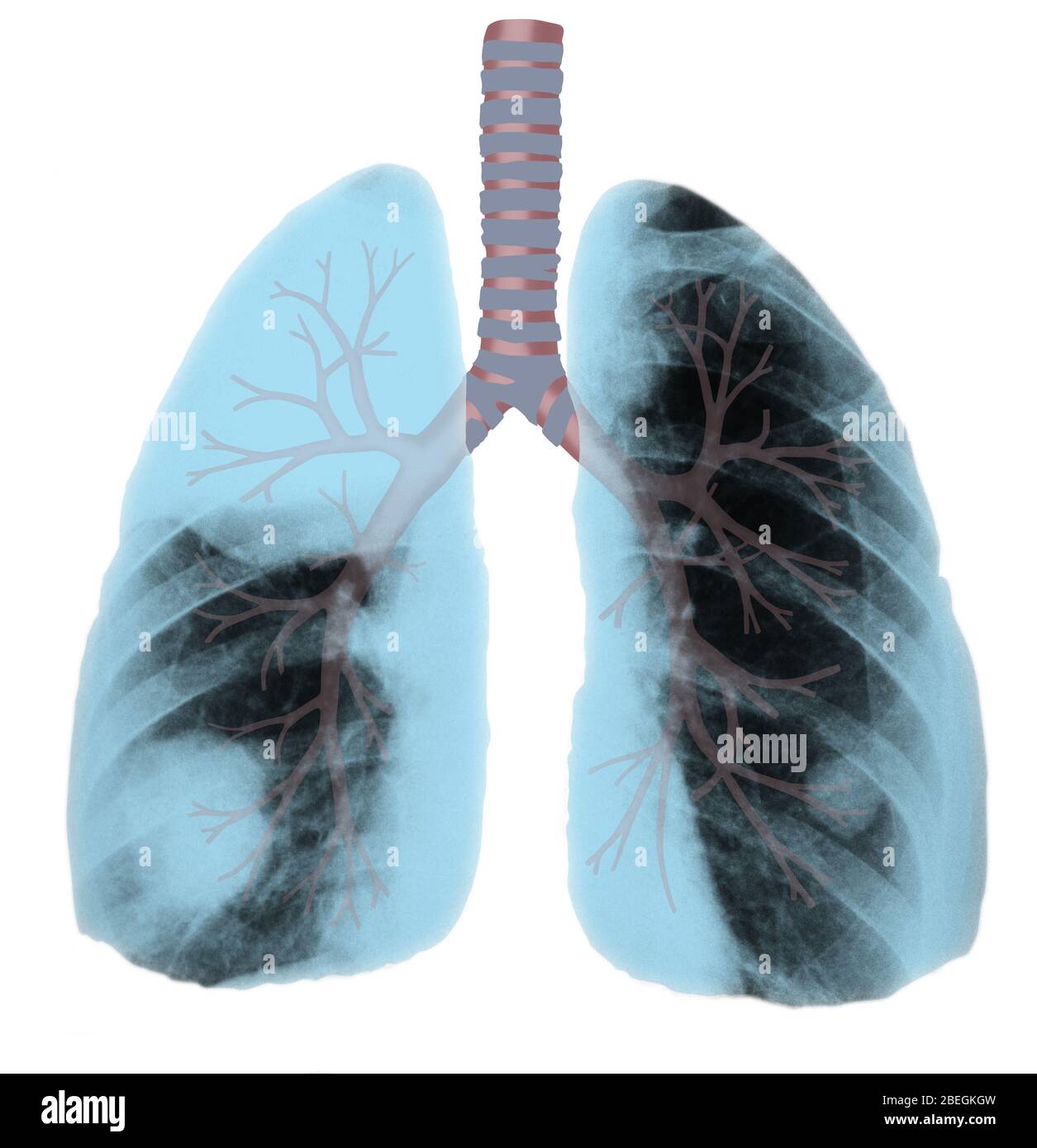 A cancro di polmone immagini e fotografie stock ad alta risoluzione - Alamy