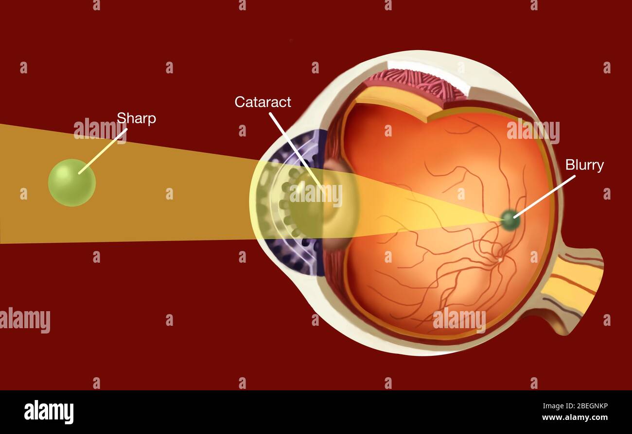 Cataratta completa immagini e fotografie stock ad alta risoluzione - Alamy