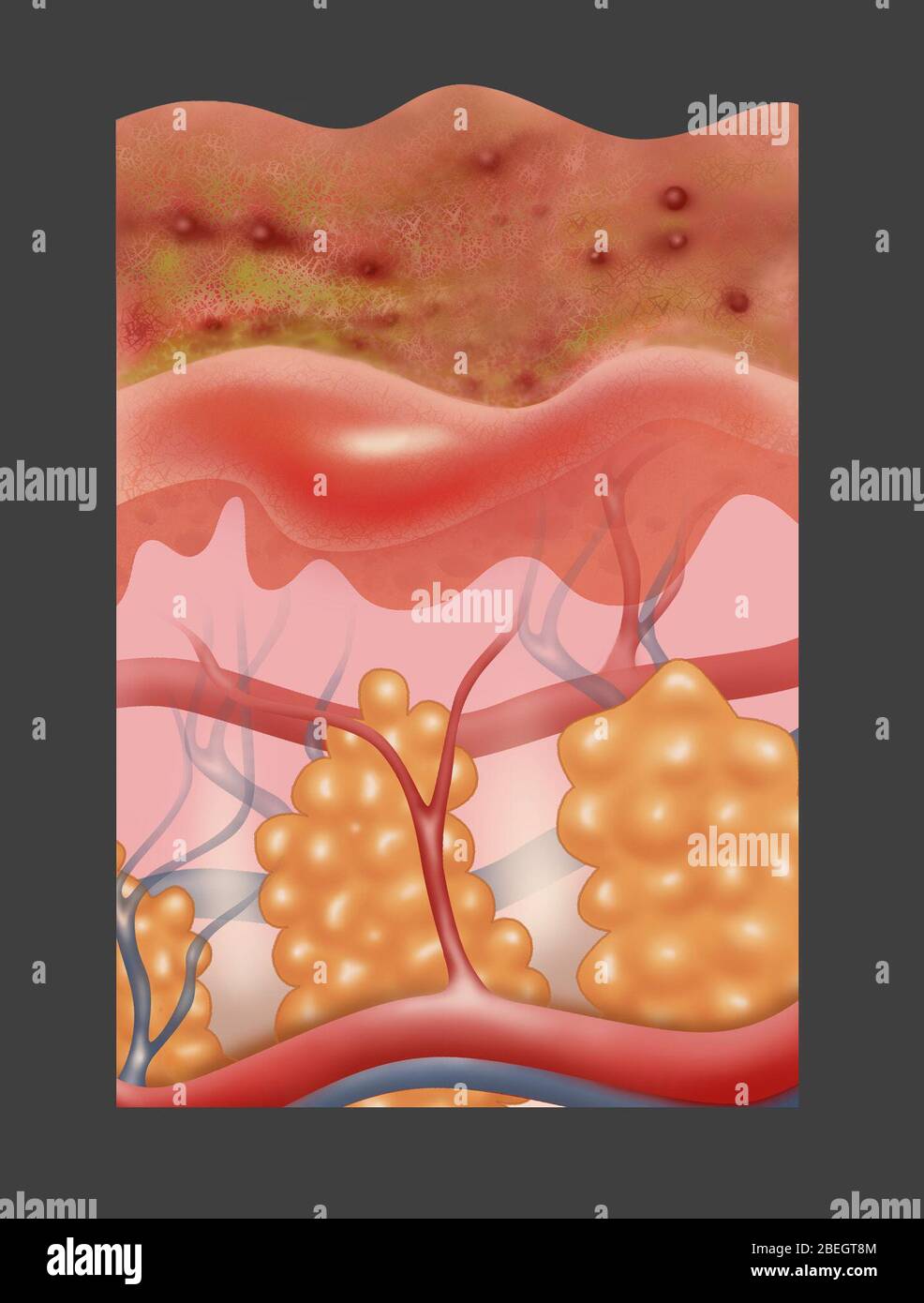 Eczema acuto immagini e fotografie stock ad alta risoluzione - Alamy