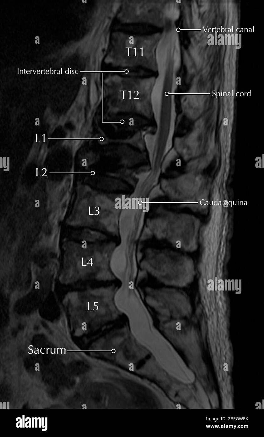 Mri di collasso vertebrale immagini e fotografie stock ad alta ...
