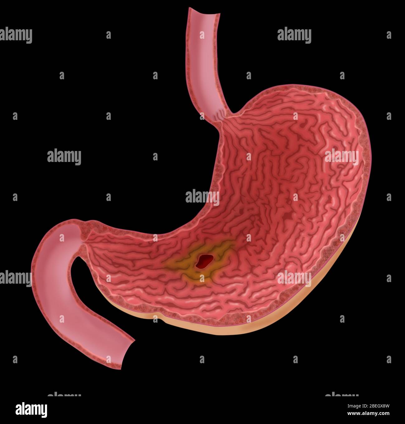 Ulcera gastrica immagini e fotografie stock ad alta risoluzione - Alamy