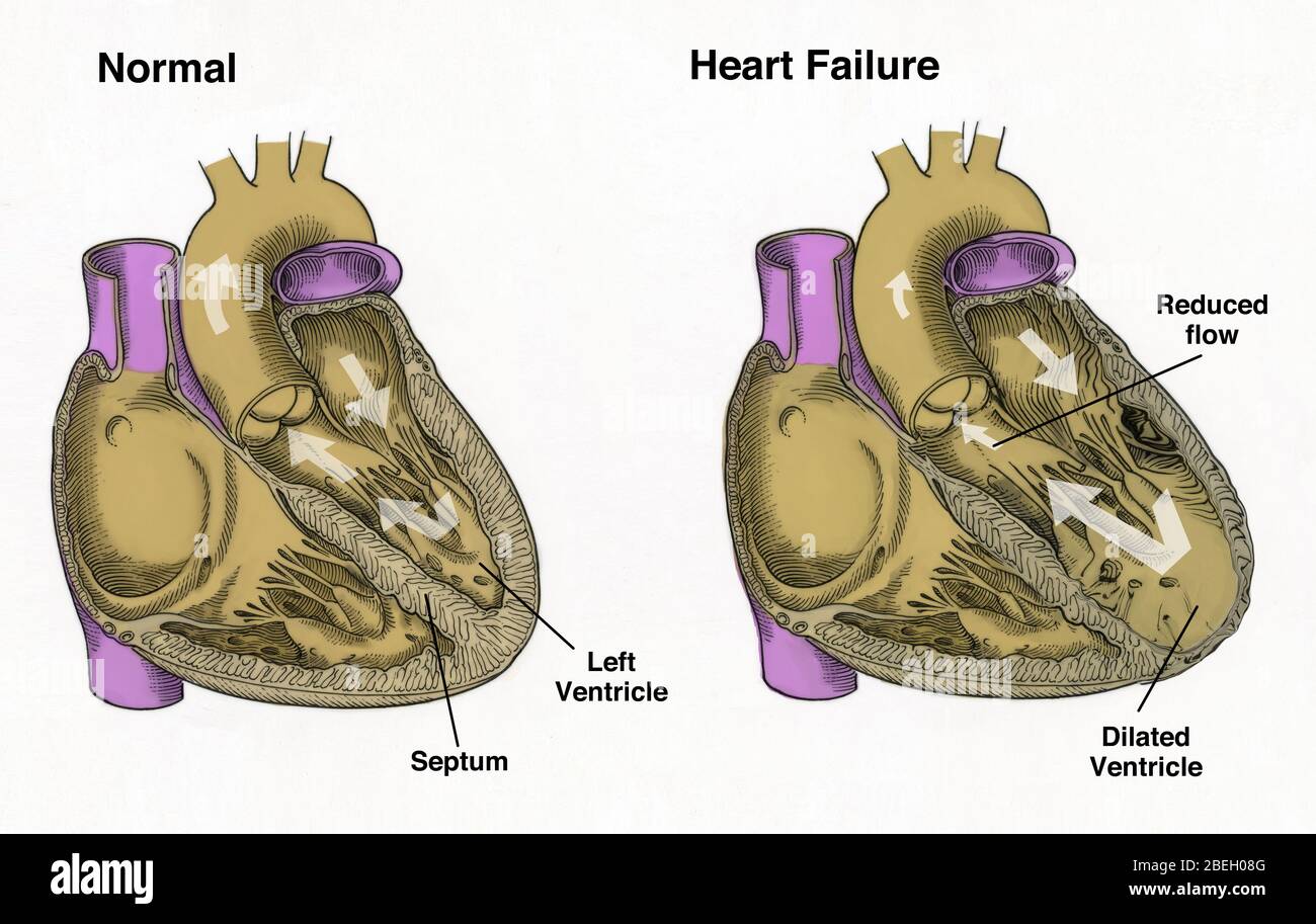 Segni di insufficienza cardiaca immagini e fotografie stock ad alta ...
