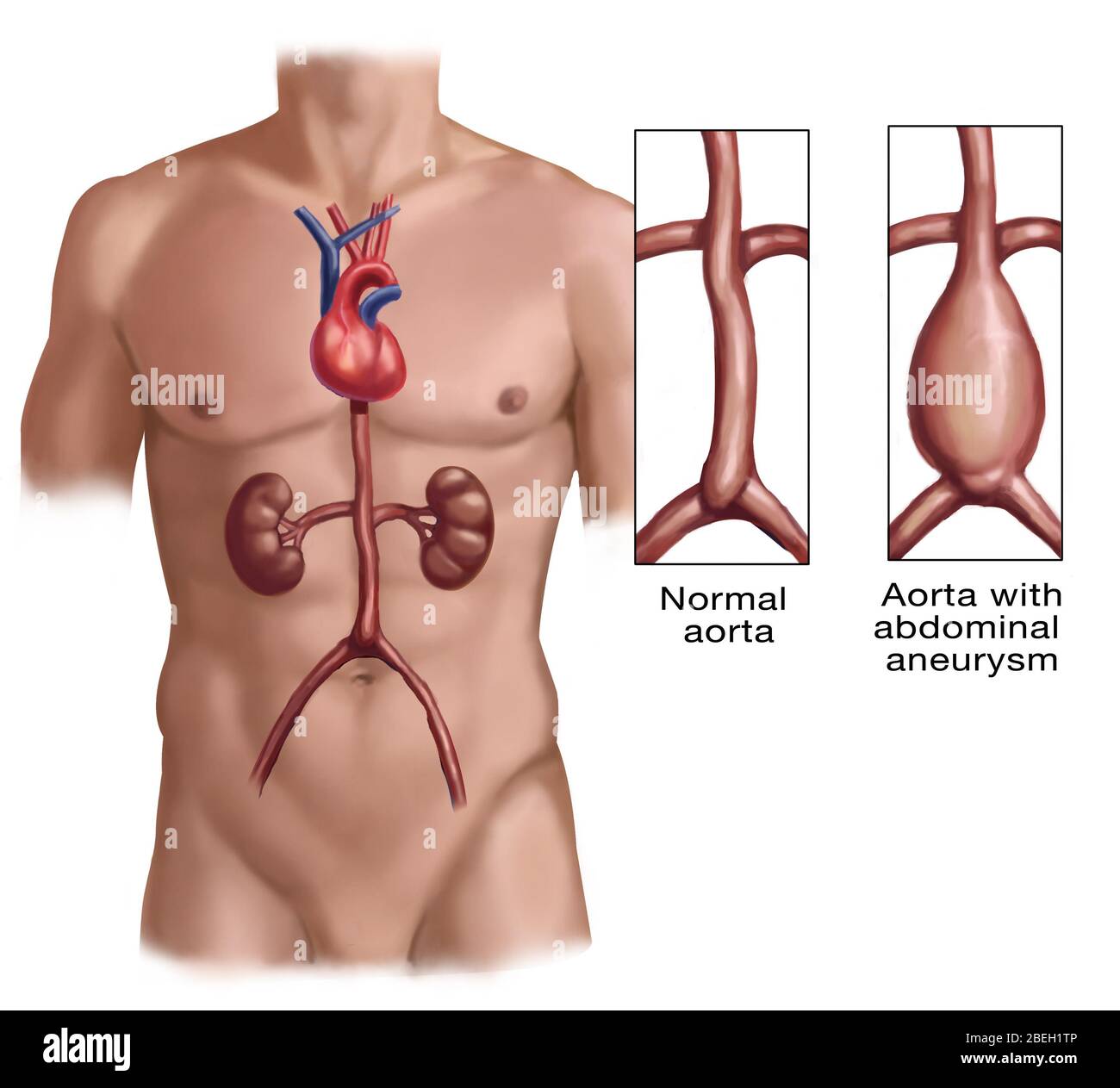 Aorta addominale immagini e fotografie stock ad alta risoluzione - Alamy