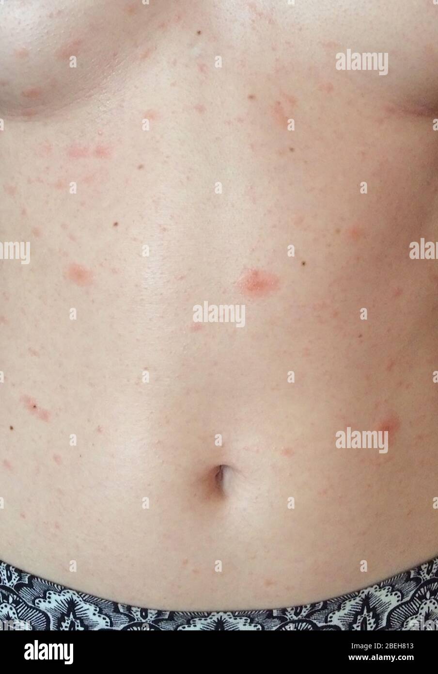 Pityriasis rosea skin immagini e fotografie stock ad alta risoluzione ...
