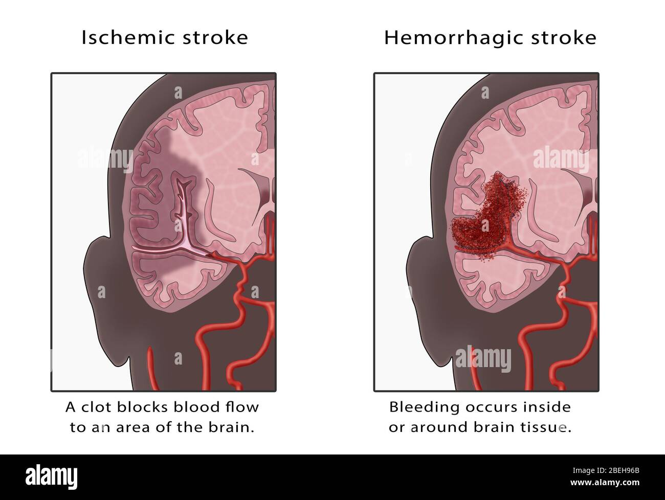 Ischemic stroke immagini e fotografie stock ad alta risoluzione - Alamy