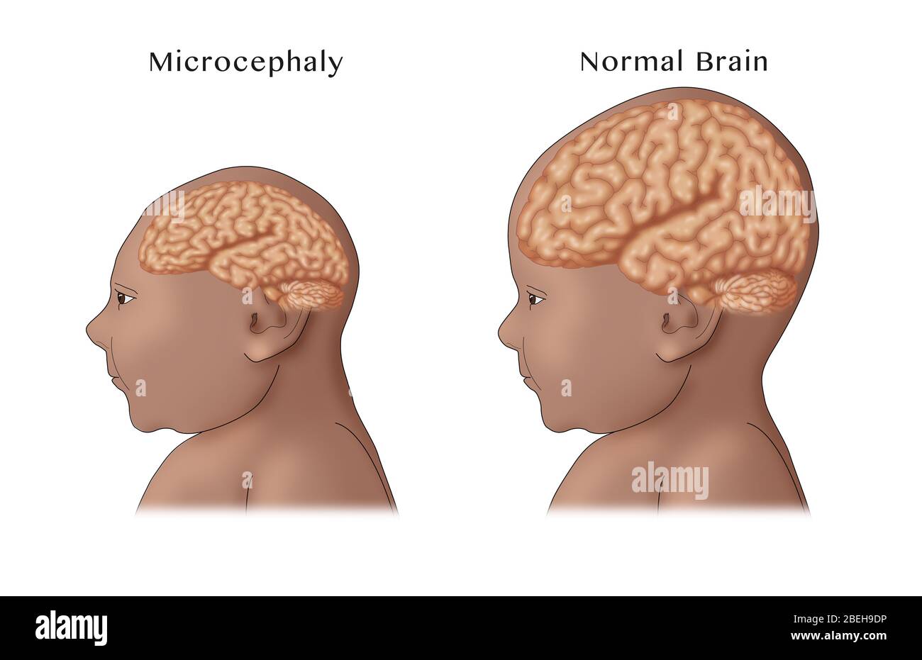 Microcefalia congenita immagini e fotografie stock ad alta risoluzione ...