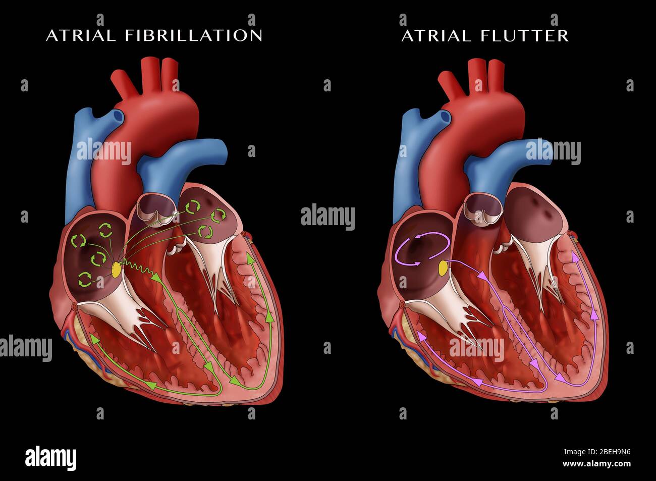 Flutter atriale immagini e fotografie stock ad alta risoluzione - Alamy