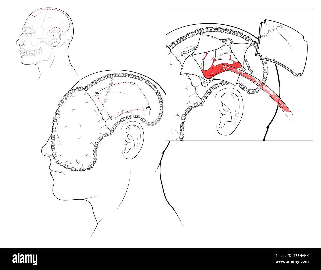 Craniectomia decompressiva immagini e fotografie stock ad alta ...