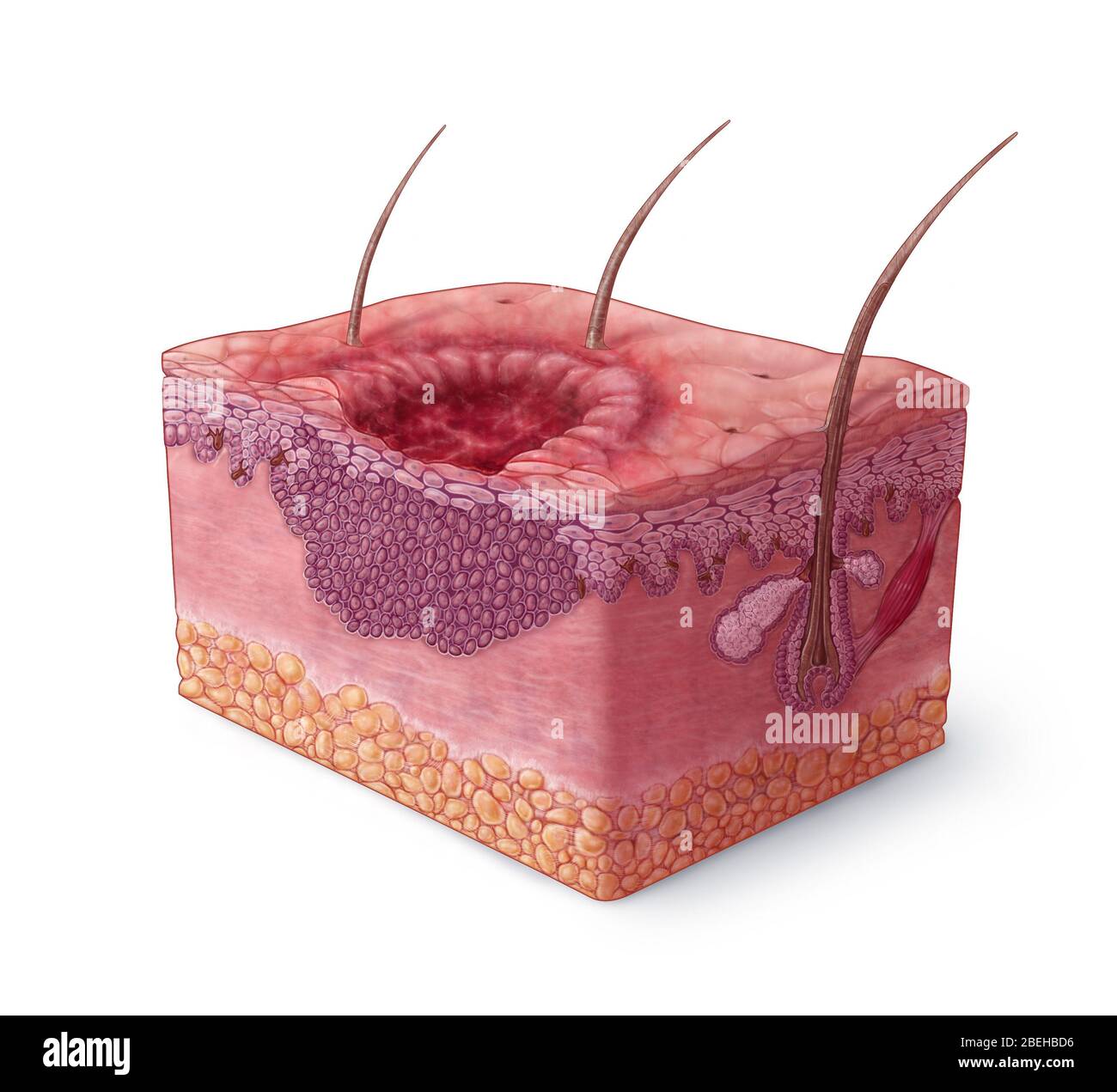 Carcinoma delle cellule basali immagini e fotografie stock ad alta ...