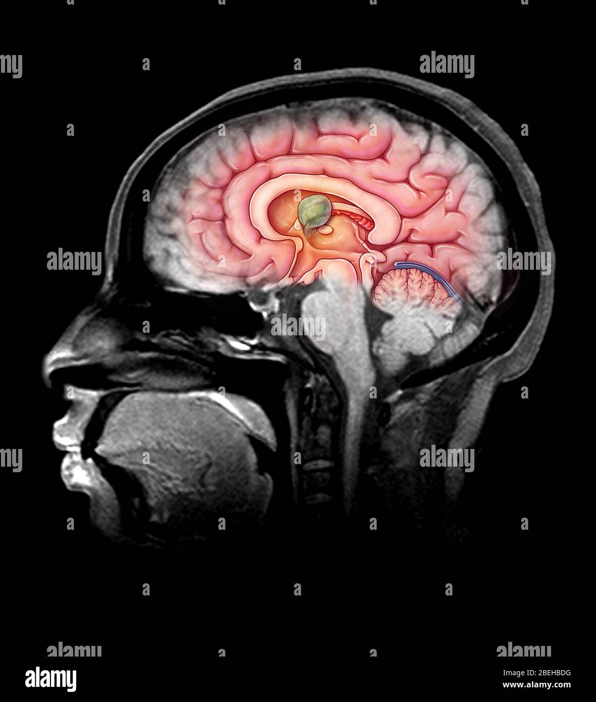 Ventricolo del cervello immagini e fotografie stock ad alta risoluzione ...