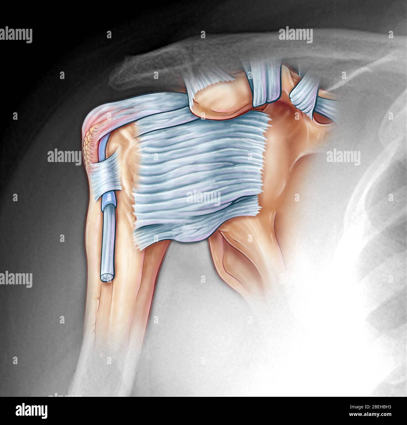 Tendinite calcifica immagini e fotografie stock ad alta risoluzione - Alamy