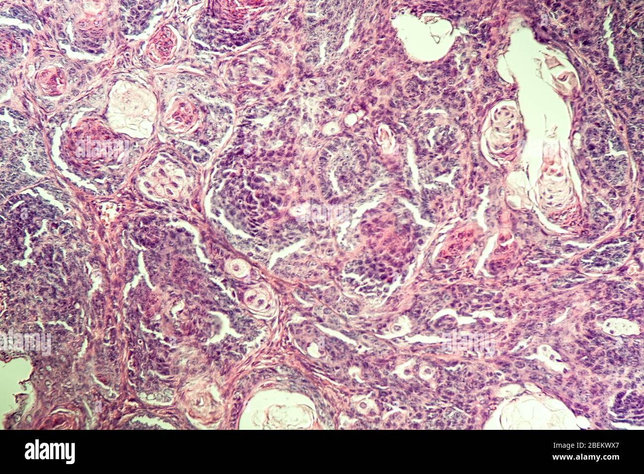 Carcinoma spinale immagini e fotografie stock ad alta risoluzione - Alamy