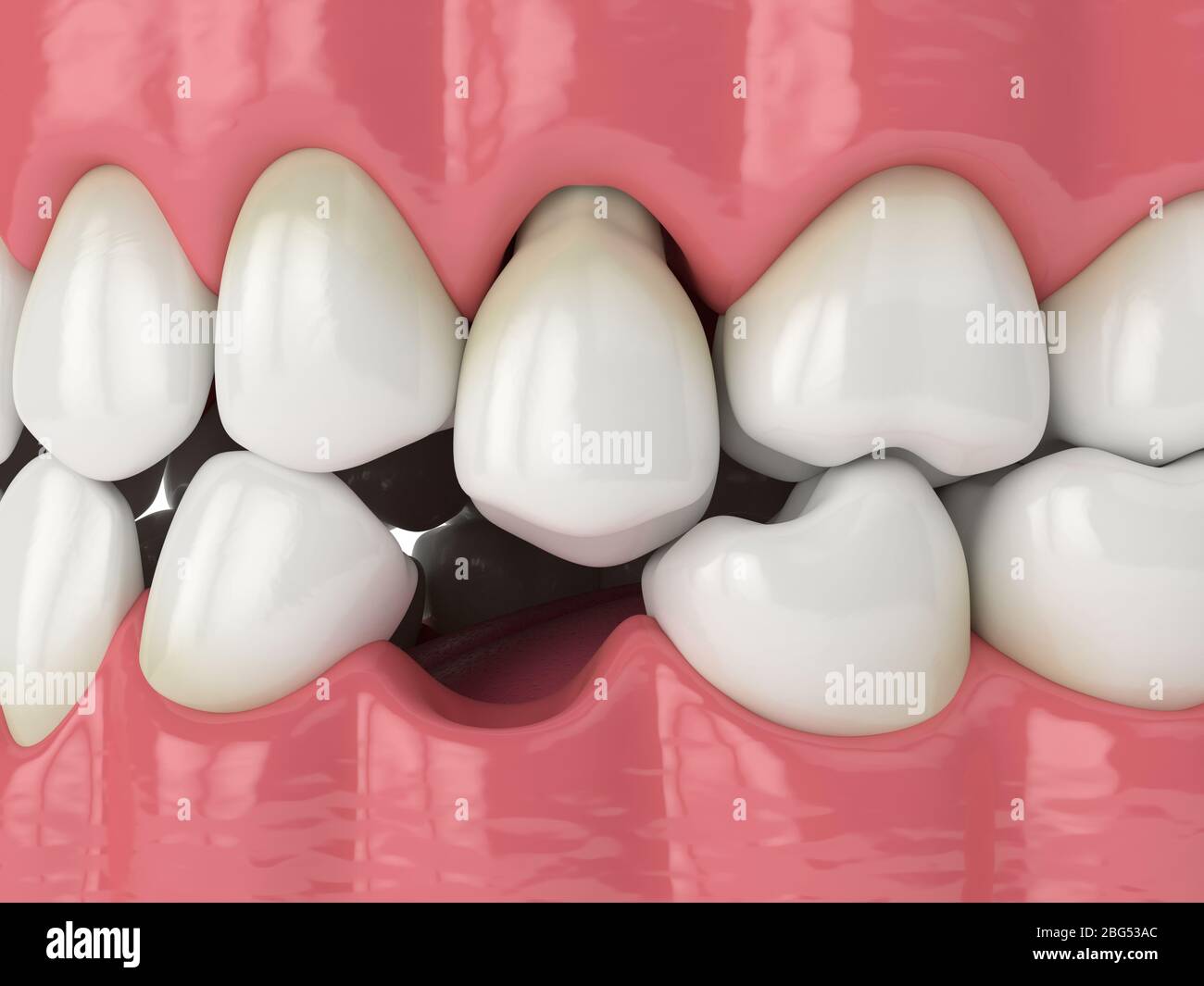 rappresentazione 3d della mascella con radice di rivelazione del dente ...