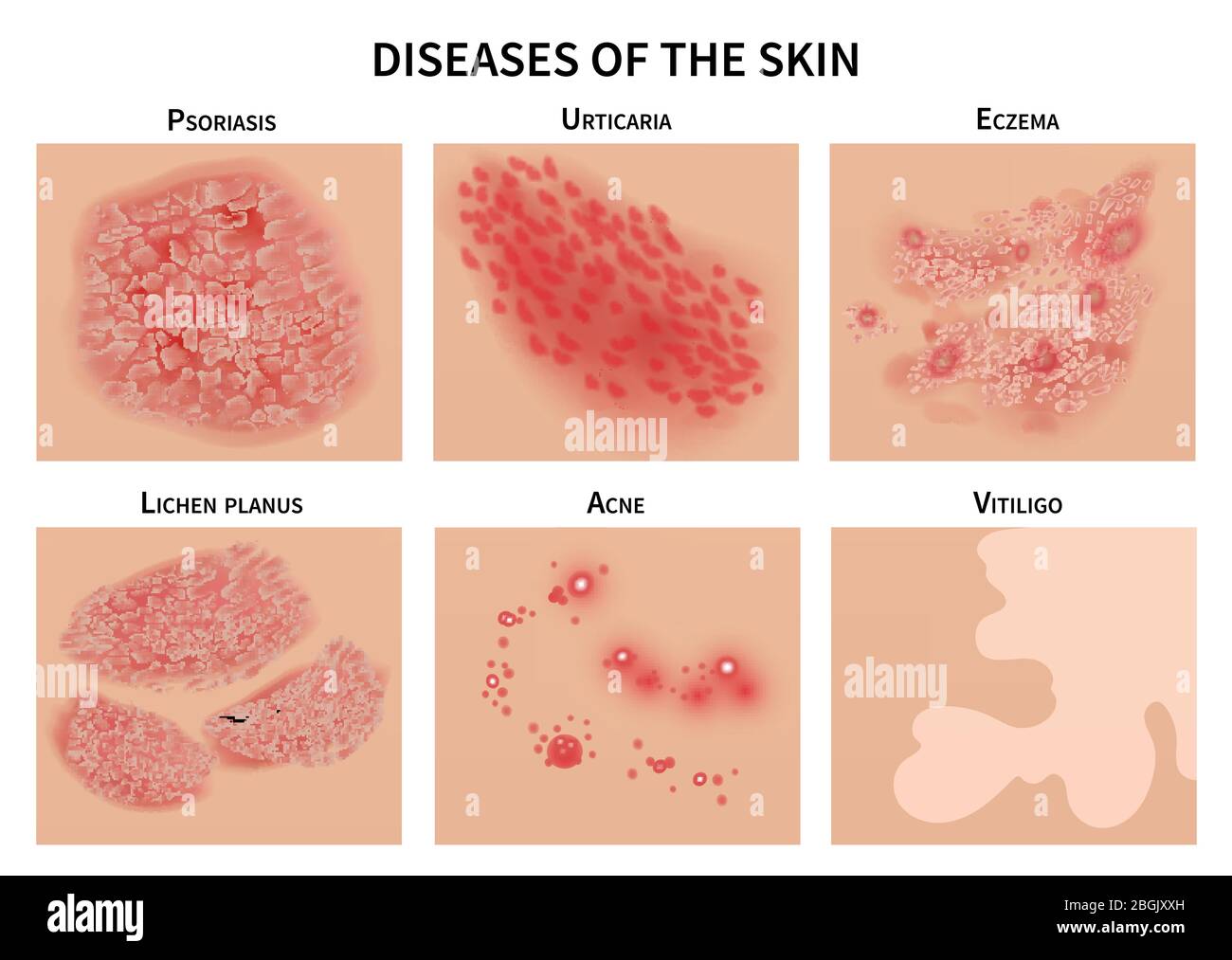 Malattie della pelle. Infezione da derma, eczema e psoriasi ...