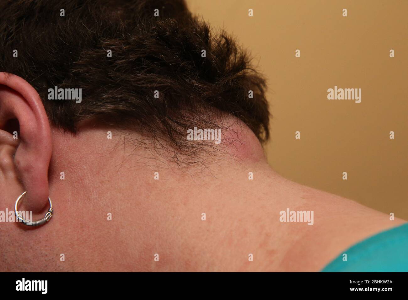 Cisti sebacea orecchio immagini e fotografie stock ad alta risoluzione ...