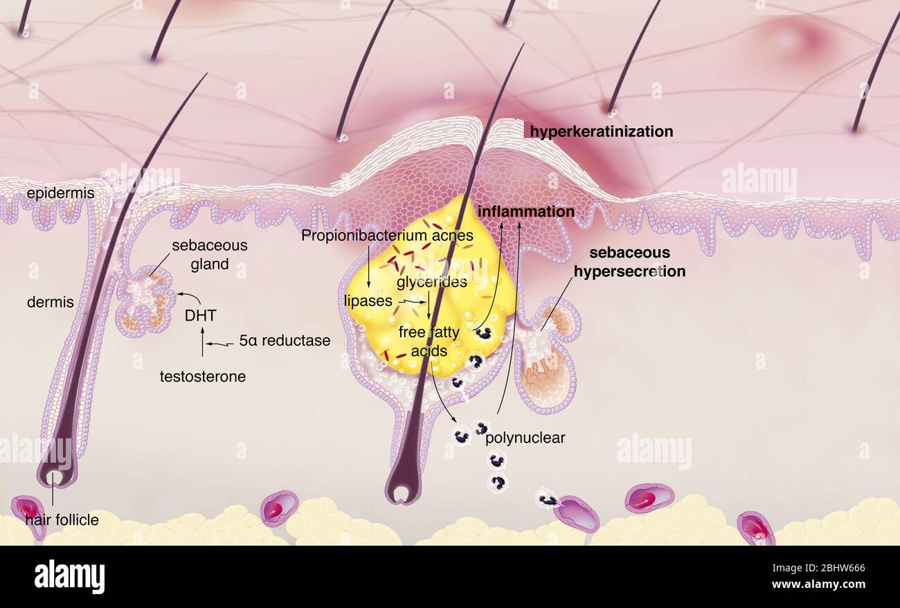 Infiammazione dell'epidermide immagini e fotografie stock ad alta ...