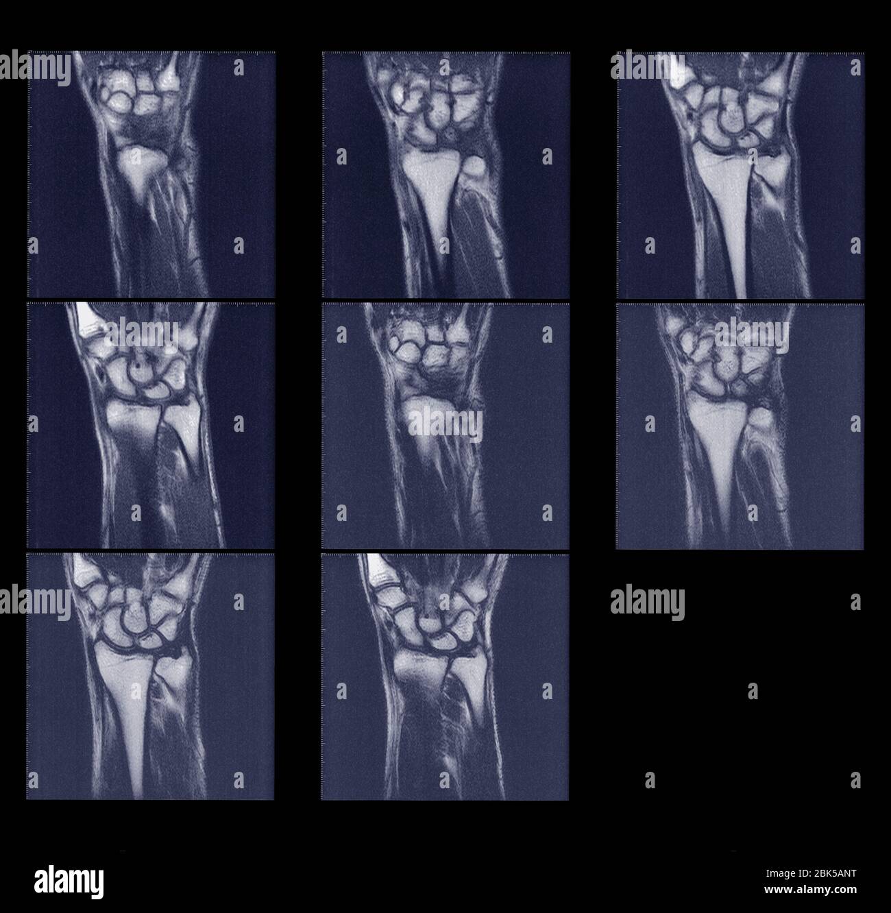 Osso del polso immagini e fotografie stock ad alta risoluzione - Alamy