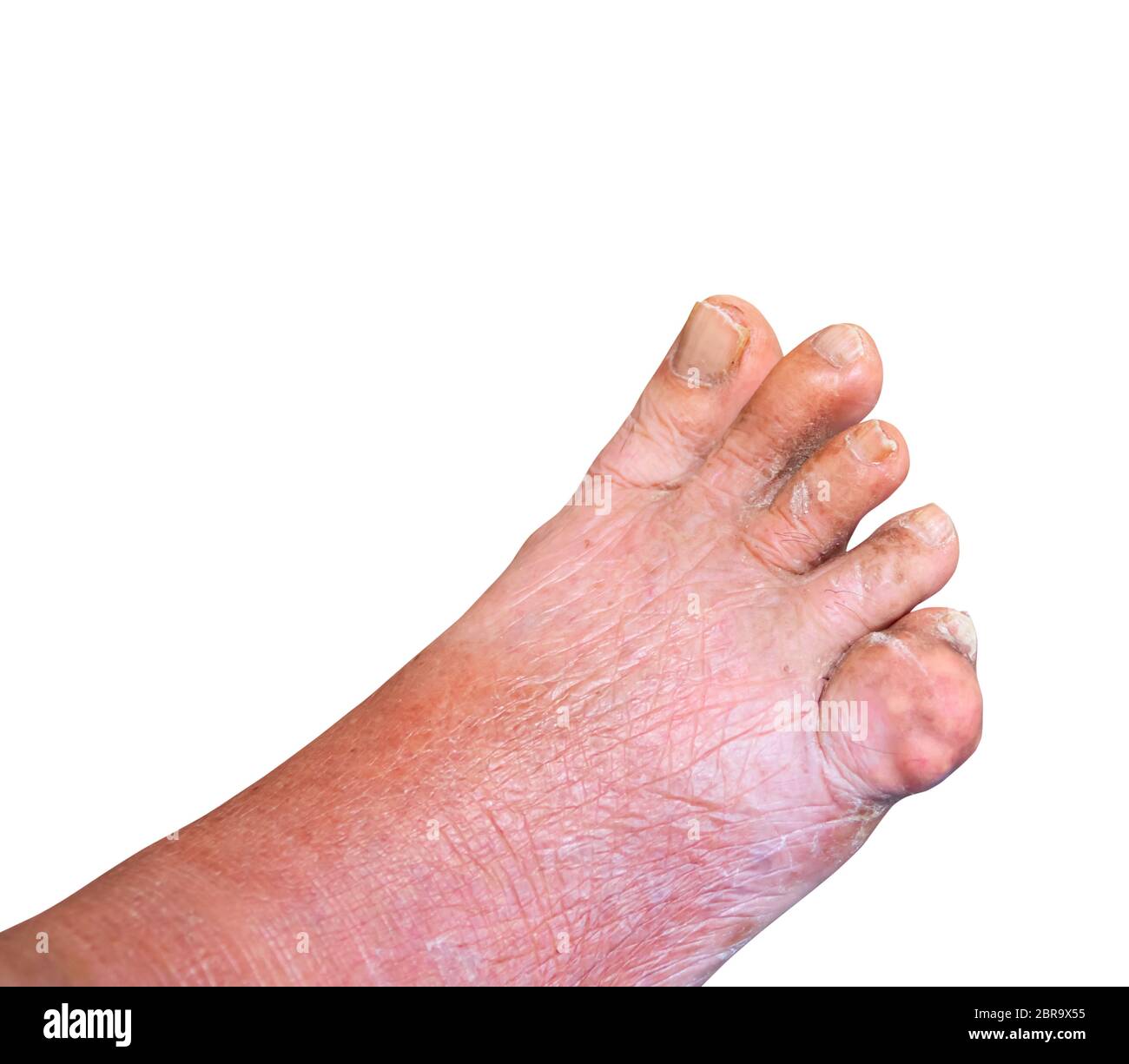 Piede Reumatoide Immagini e Fotos Stock - Alamy