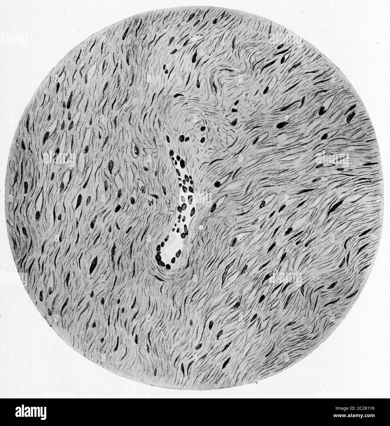 Fibroma molle immagini e fotografie stock ad alta risoluzione - Alamy