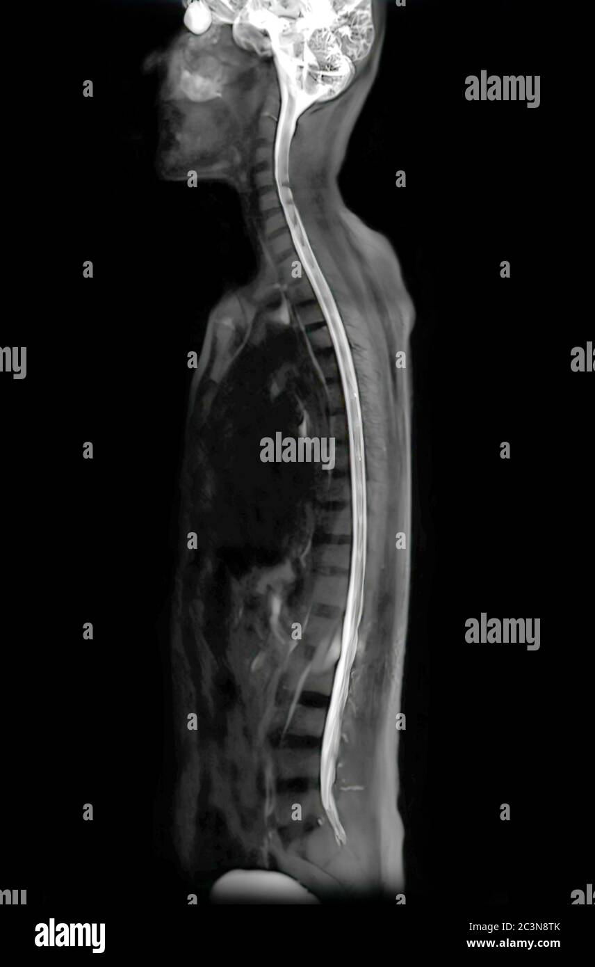MRI della colonna vertebrale intera utilizzare la tecnica mielogramma ...