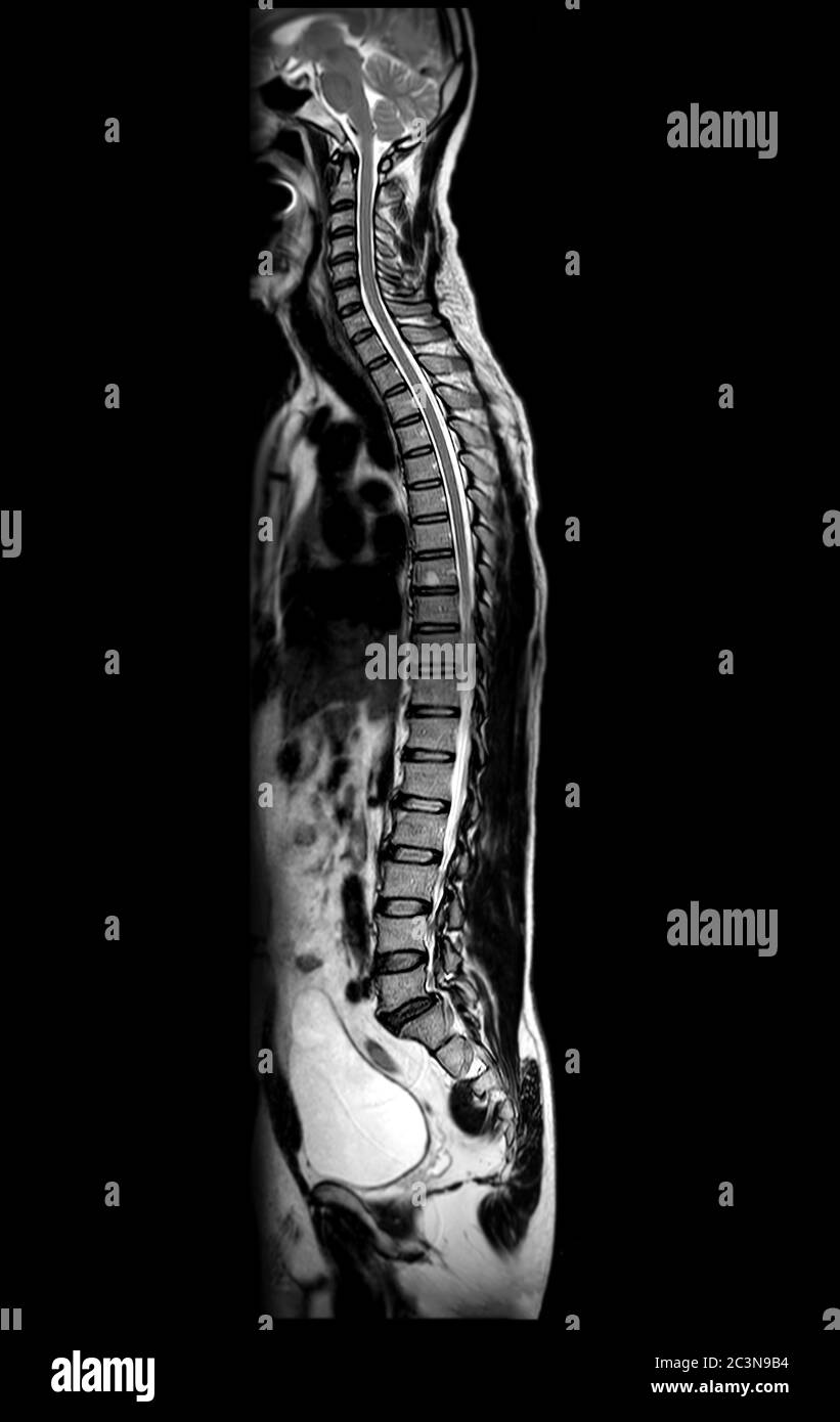 MRI del piano sagittale T2W della colonna intera per la compressione ...