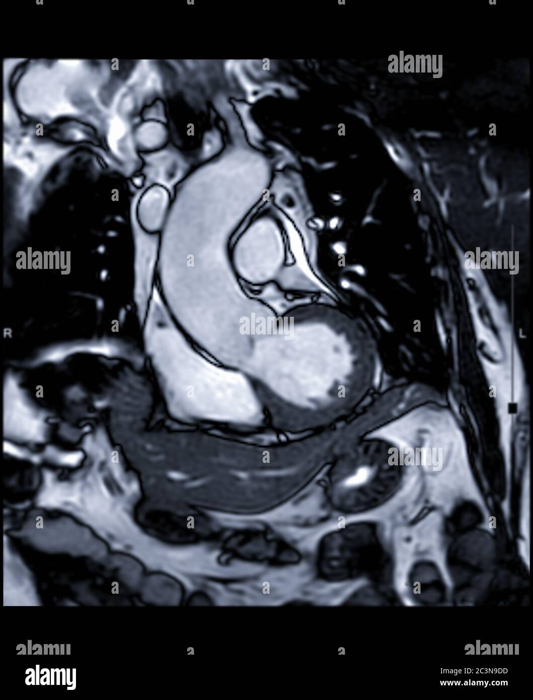 MRI cuore o risonanza magnetica cardiaca (risonanza magnetica) della ...
