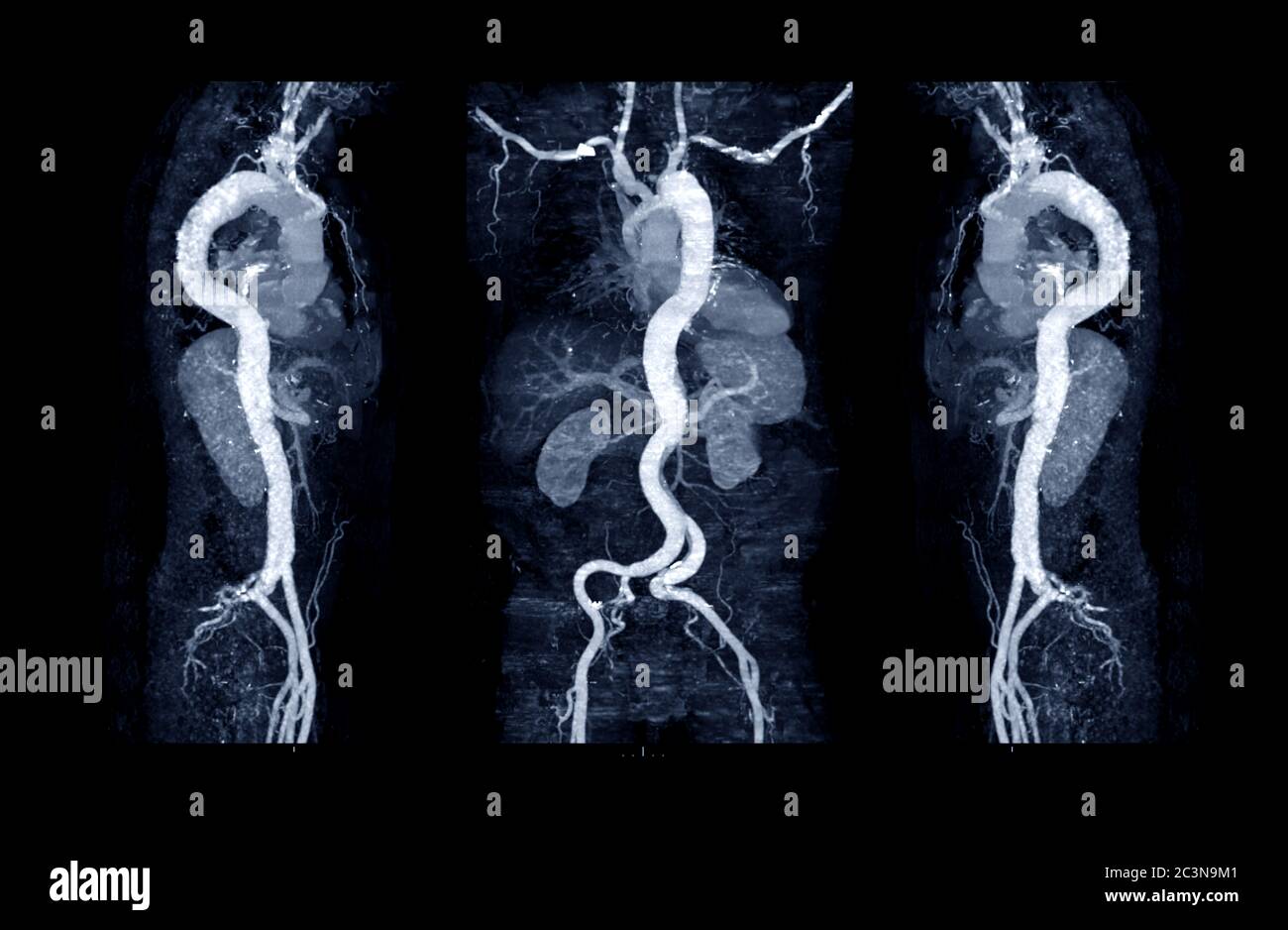 Aorta Addominale Immagini e Fotos Stock - Pagina 2 - Alamy