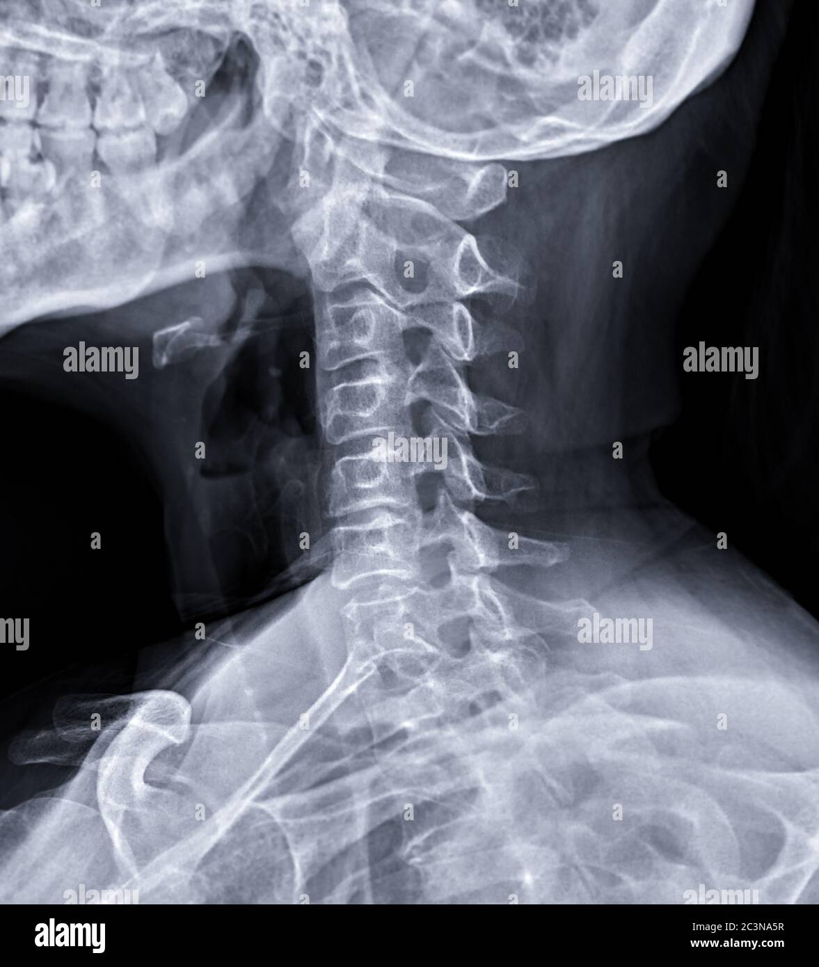 Immagine radiografica della colonna C o radiografica della vista ... Immagine radiografica della colonna C o radiografica della vista ...