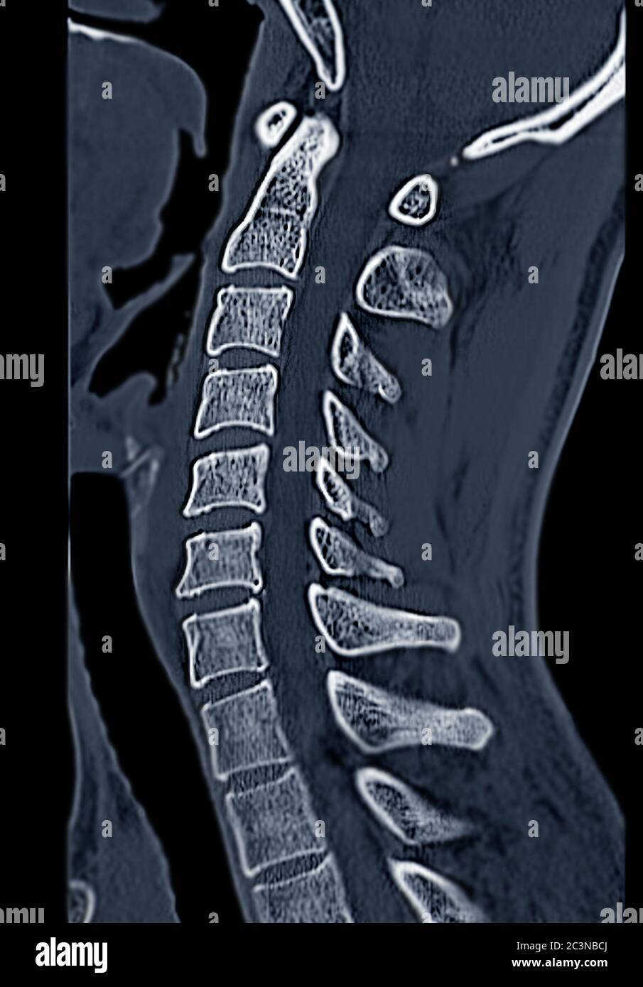 Lesione della colonna vertebrale cervicale immagini e fotografie stock ...