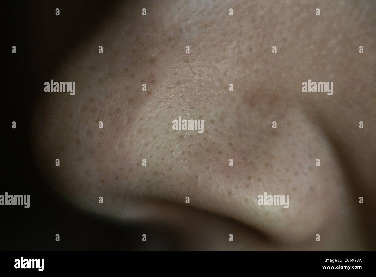 Brufolo sul naso immagini e fotografie stock ad alta risoluzione - Alamy