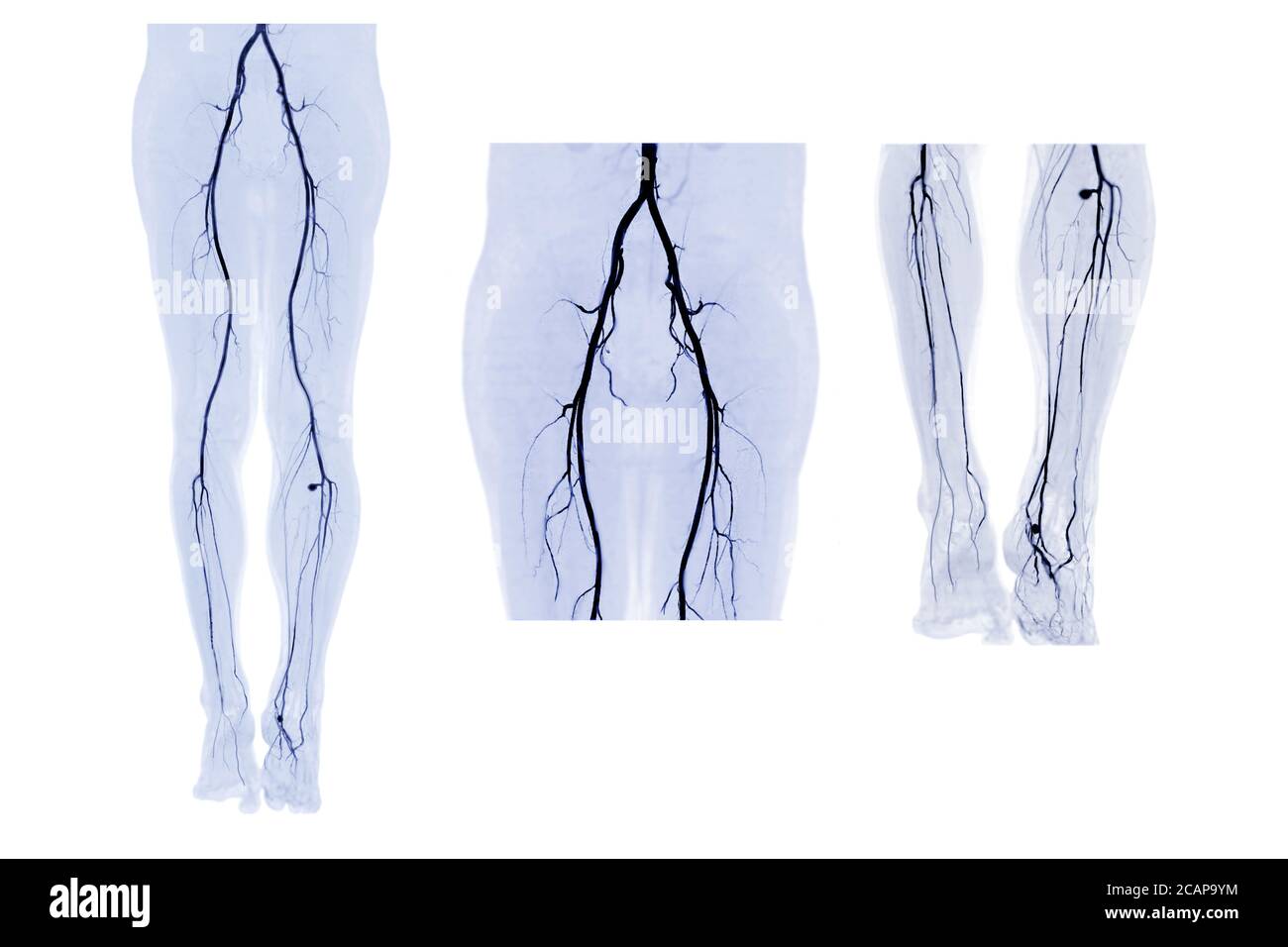 Arterias femoral immagini e fotografie stock ad alta risoluzione - Alamy