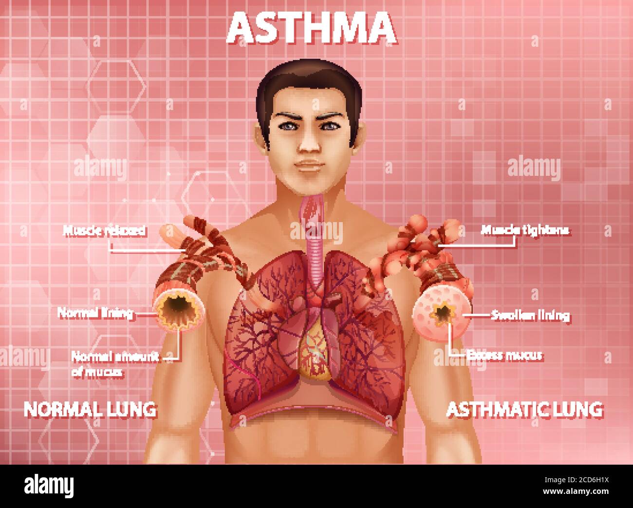 Patologia Dell'asma Immagini e Fotos Stock - Alamy