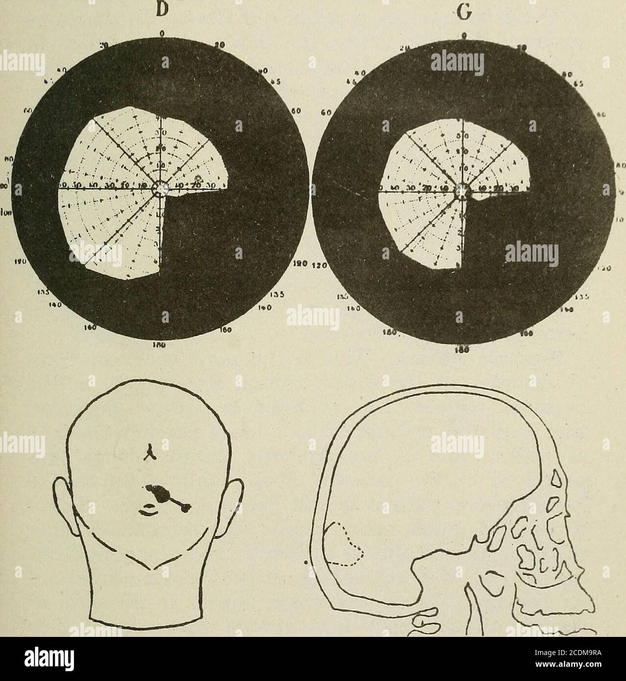 External occipital protuberance immagini e fotografie stock ad alta ...