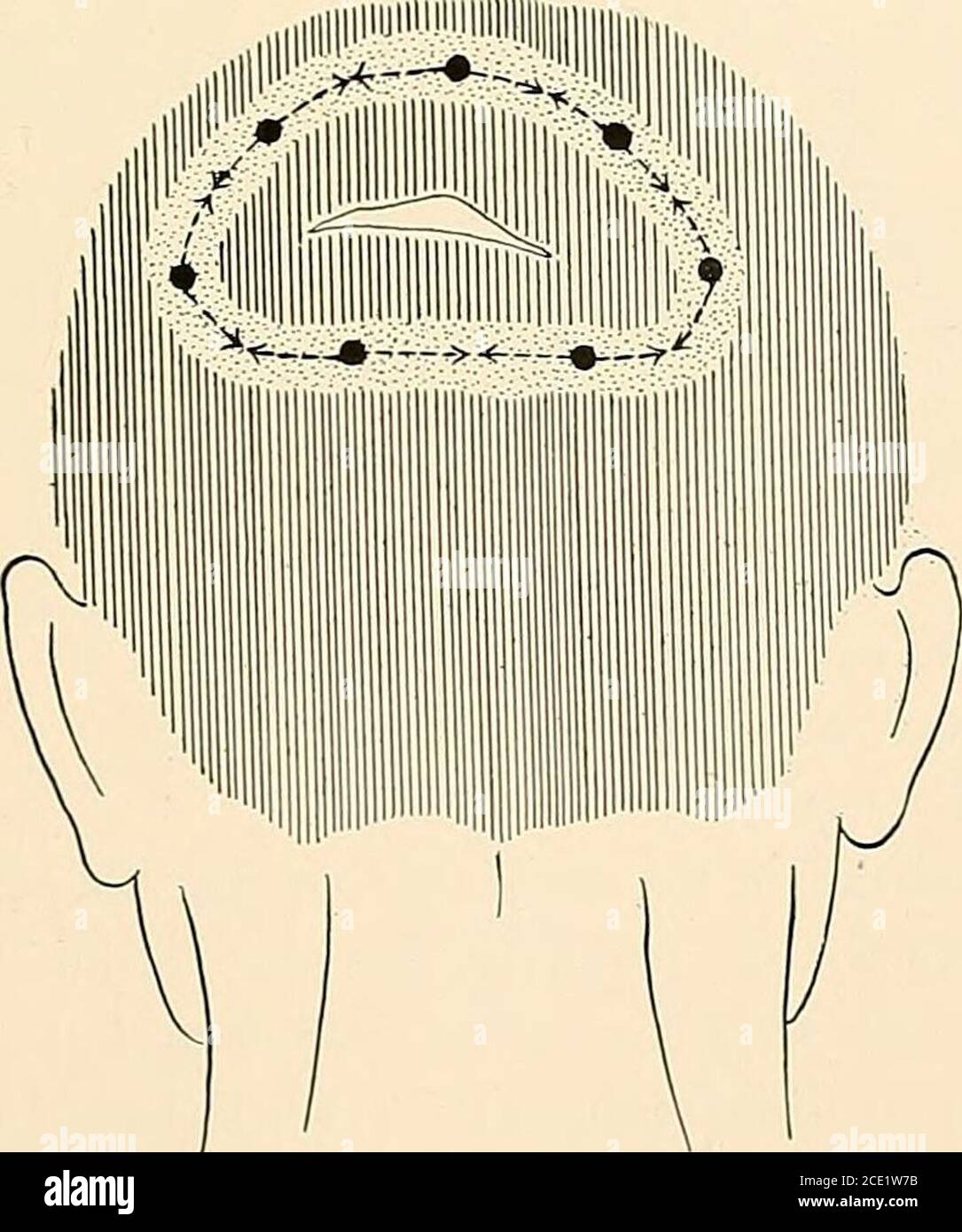 Cisti sebacea in testa immagini e fotografie stock ad alta risoluzione ...