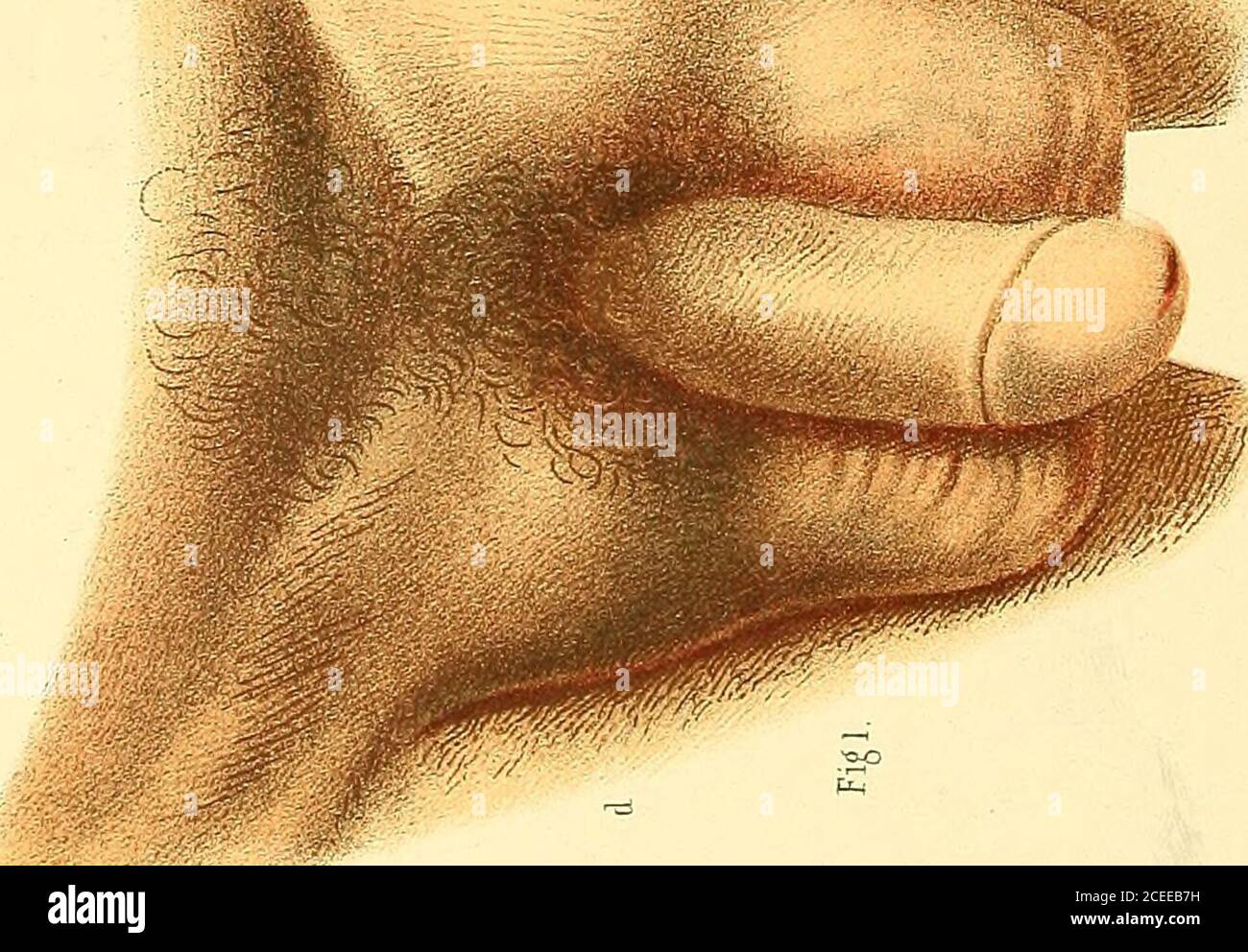 Ernia inguinale sintomi immagini e fotografie stock ad alta risoluzione ...