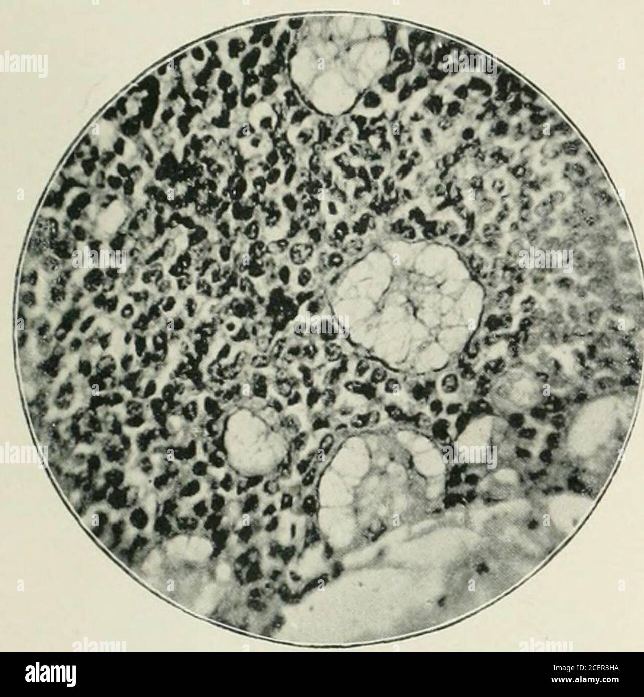 Cellule epiteliali atipiche immagini e fotografie stock ad alta ...