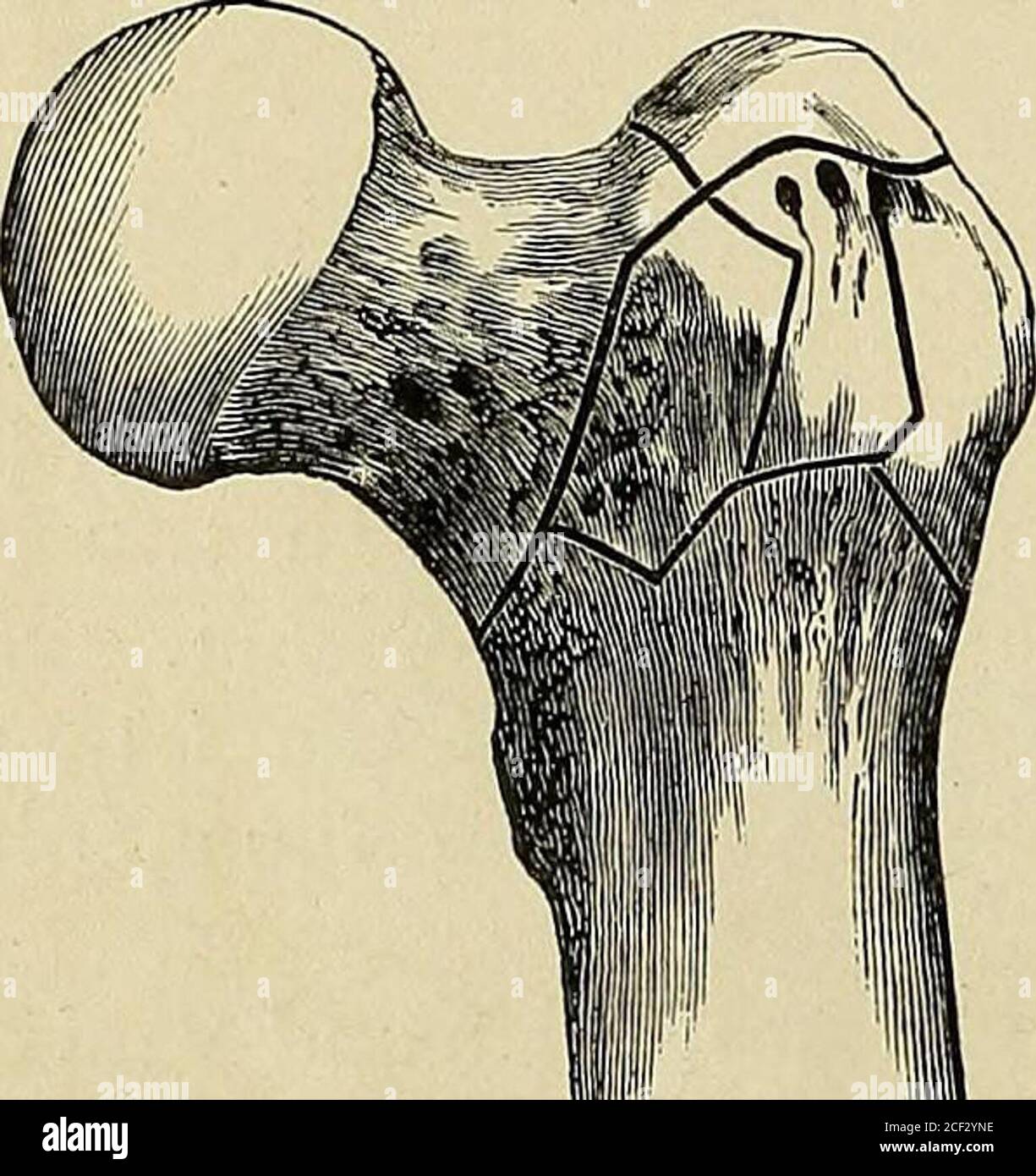 . Un trattato pratico sulle fratture e le dislocazioni. Frattura del ...