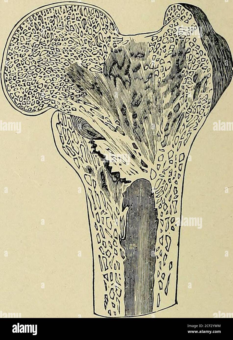 . Un trattato pratico sulle fratture e le dislocazioni. Frattura del ...