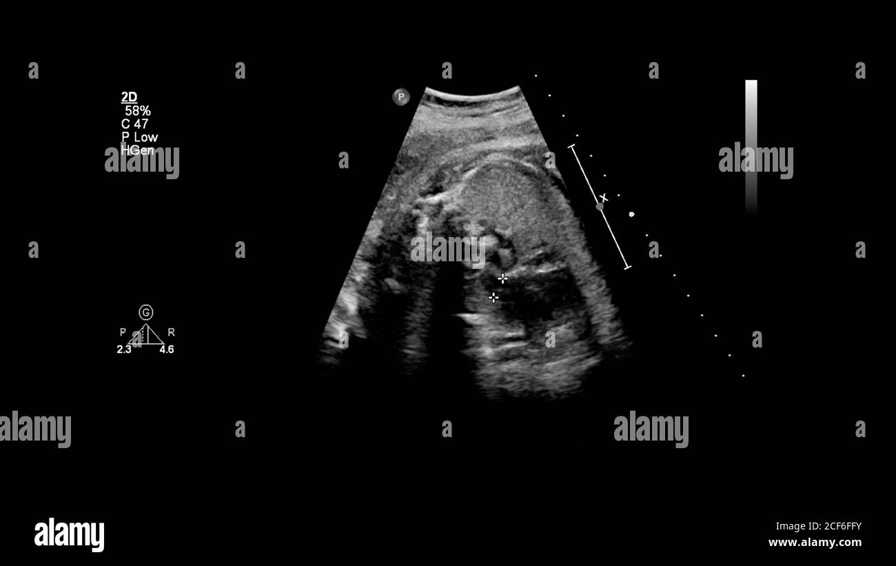 Ecocardiografia ecografica Foto e Immagini Stock in Bianco e Nero - Alamy