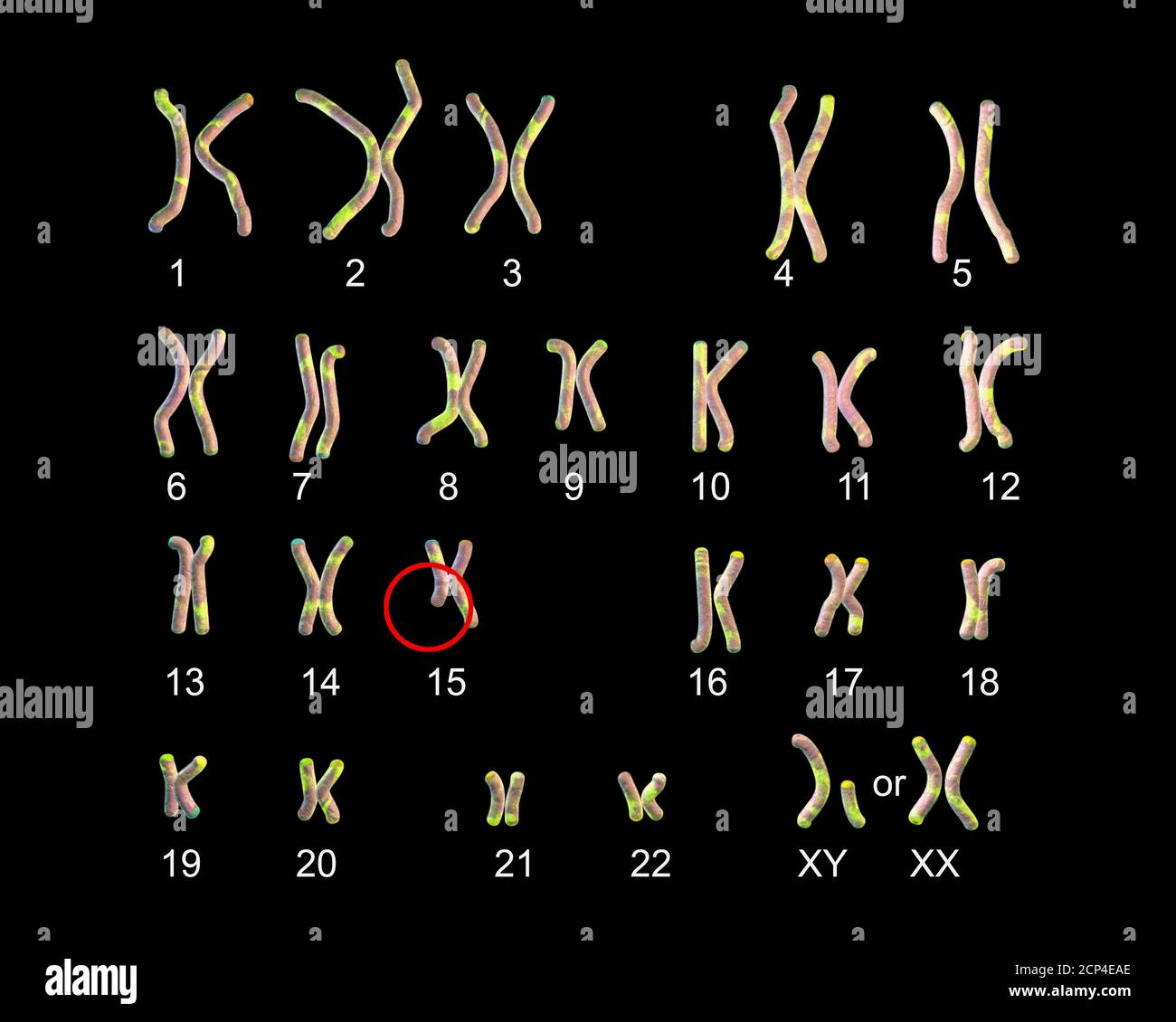 Cariotipo della sindrome di Angelman (AS), illustrazione del computer ...